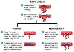 Haemophilia- Introduction, Types, Pathophysiology, Diagnostics ...