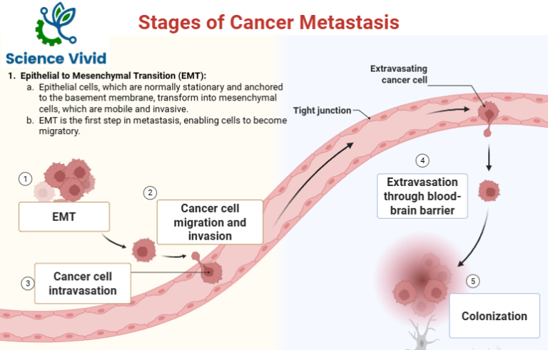 Cancer Metastasis : Stages, Molecular Mechanisms, EMT in Tumor Spread